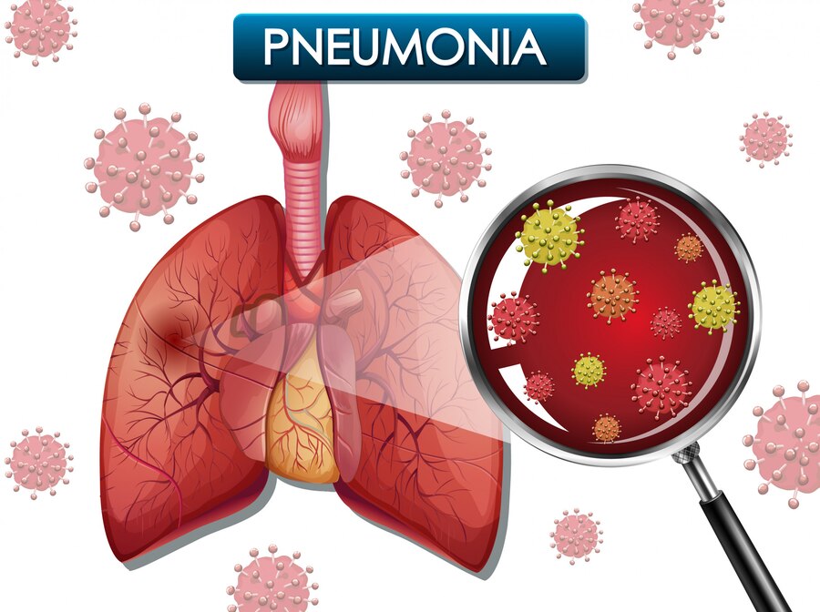 Complications of Pneumonia – Dr. Sayantan Banerjee